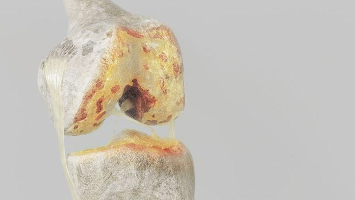 Are Your Joints Swollen? Joint Fuel 360 Health